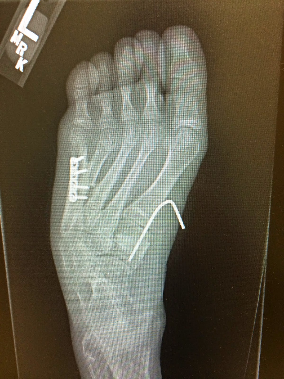 fibular hemimelia leg lengthening: Pin Removal and Walking Cast