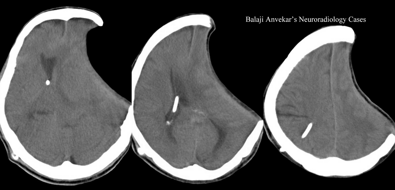 Dr Balaji Anvekar FRCR: Sinken skin flap syndrome