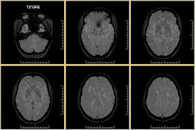 Dr Balaji Anvekar FRCR: CADASIL MRI Brain