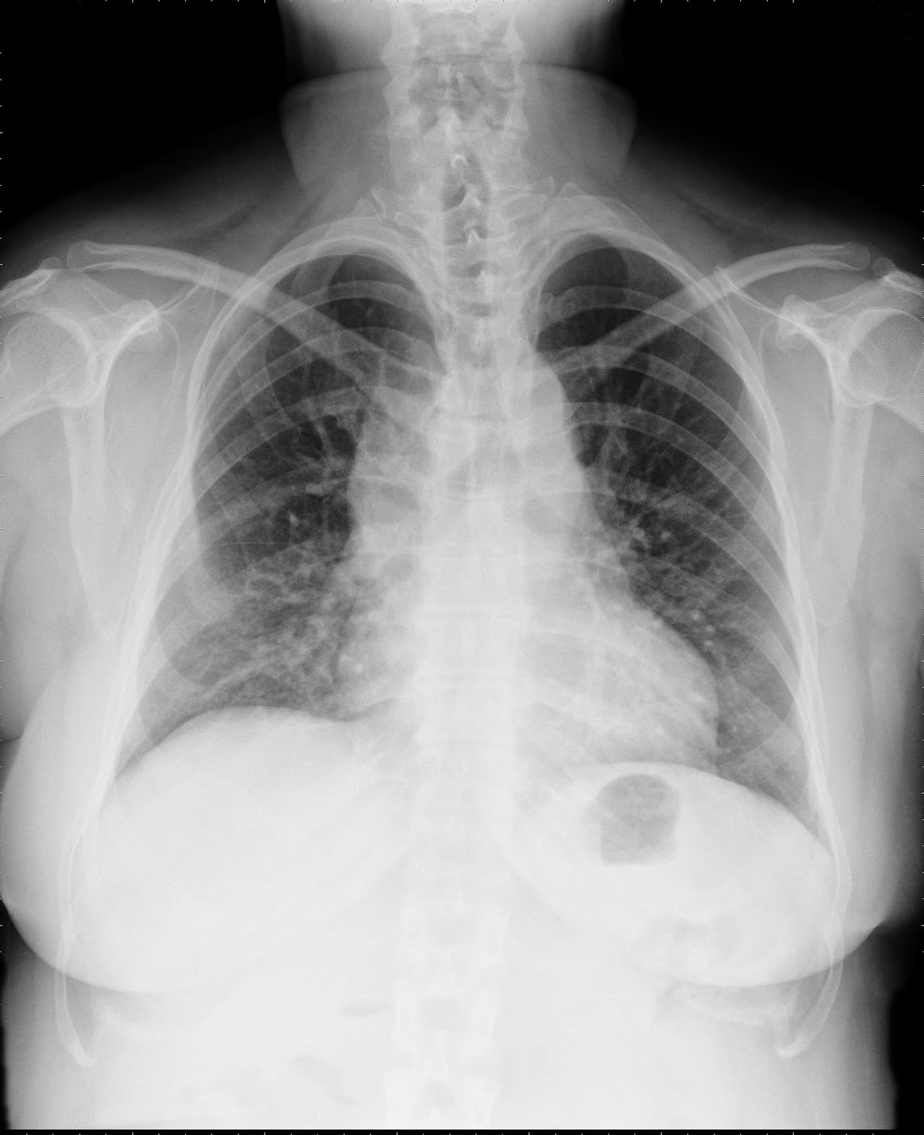 CXR 胸部x光判讀 rib hypoplasia