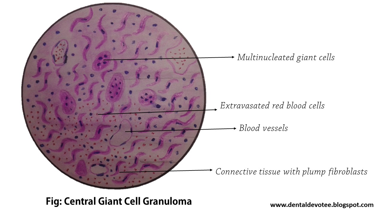 Central Giant Cell Granuloma Histology