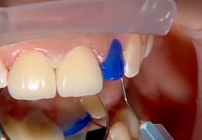 PROSTHODONTICS: Lava™ Crowns and Bridges - Michael Ditolla, DDS