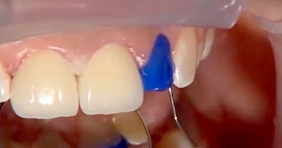 PROSTHODONTICS: Lava™ Crowns and Bridges - Michael Ditolla, DDS - Odonto-Tv