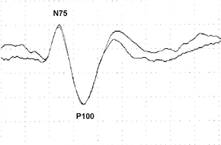 【VEP: visual evoked potential (視覚誘発電位)とは マニュアル】