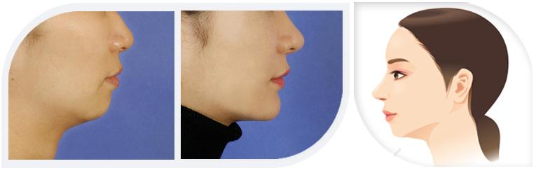 Eyelid Surgery Legend Dr. Kim Byung Gun: [BK Plastic Surgery Hospital ...