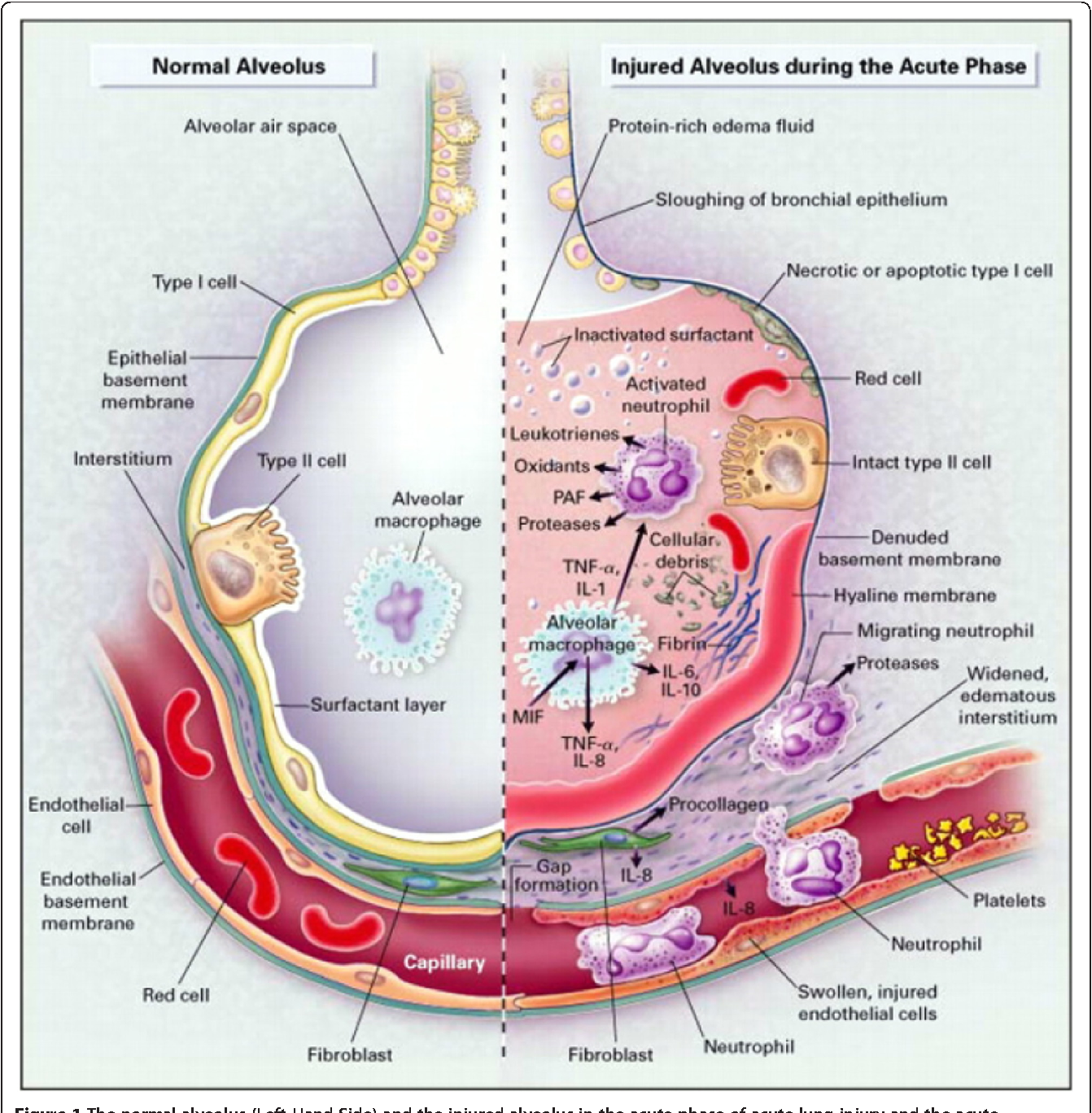 Tratamiento del SDRA. Fundamentos actuales
