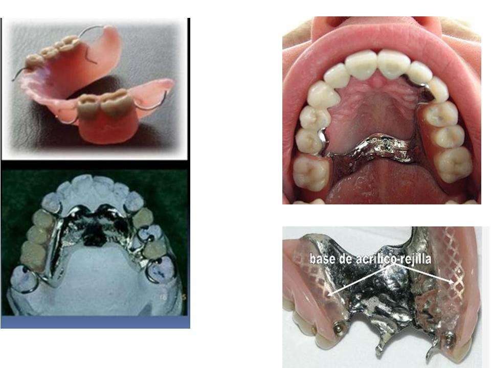REHABILITACIÓN II: Selección y colocación de dientes artificiales y ...
