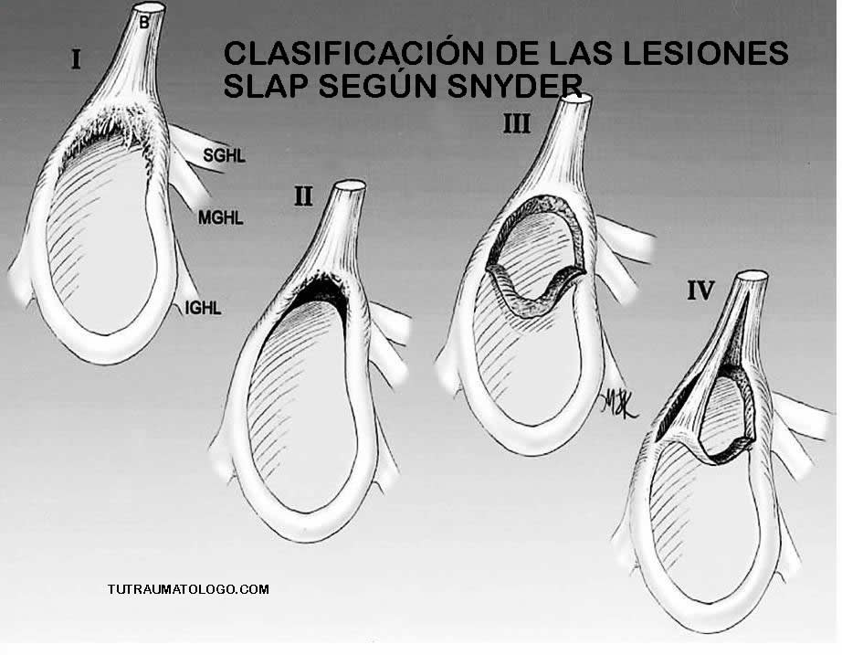 Rehabilitación: La Lesión de Slap