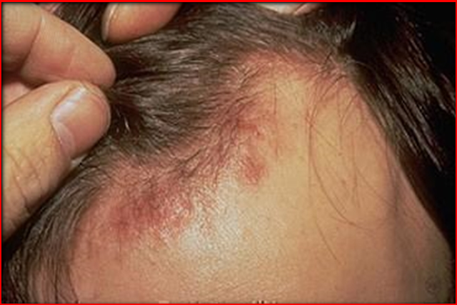 Seborrheic Dermatitis Pictures on Scalp, Face, and Infant’s Body and ...
