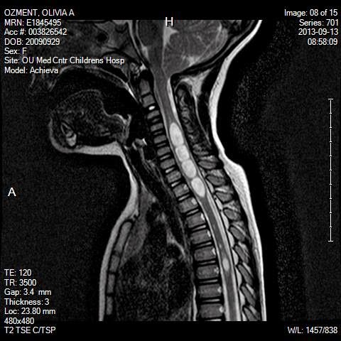 Children's Chiari Journal: More on Instability, Syrinxs/syringomyelia ...