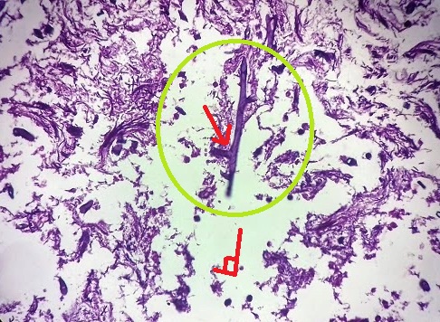 KIMAN - Making pathology simple!!: Mucormycosis - How to identify?