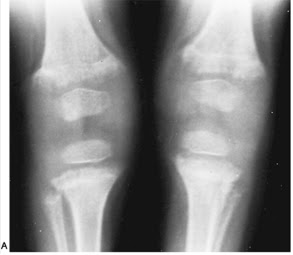 Rickets X-ray Before and After vitamin D therapy - Radiology Imaging