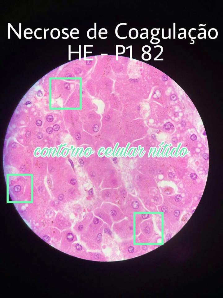 HISTOLOGIA90: TIPOS DE NECROSE