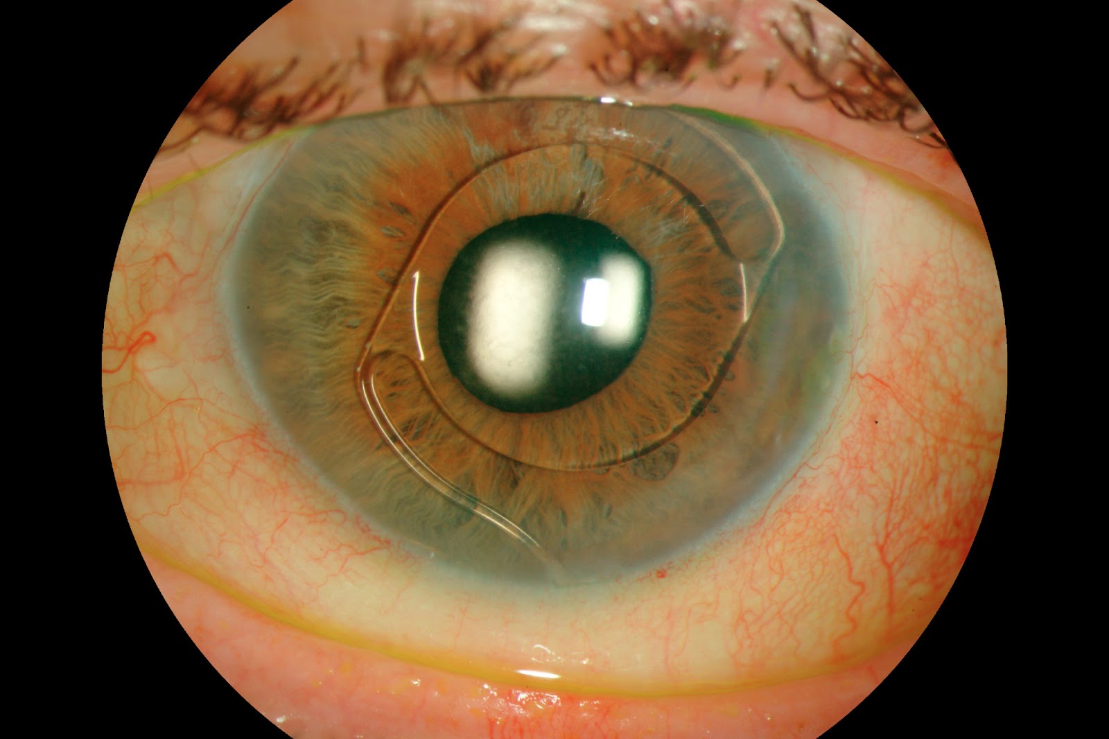 Whitman Images: AC IOL