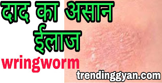 daad ke ilaj ke liye tablet aur cream- दाद का रामबाण इलाज