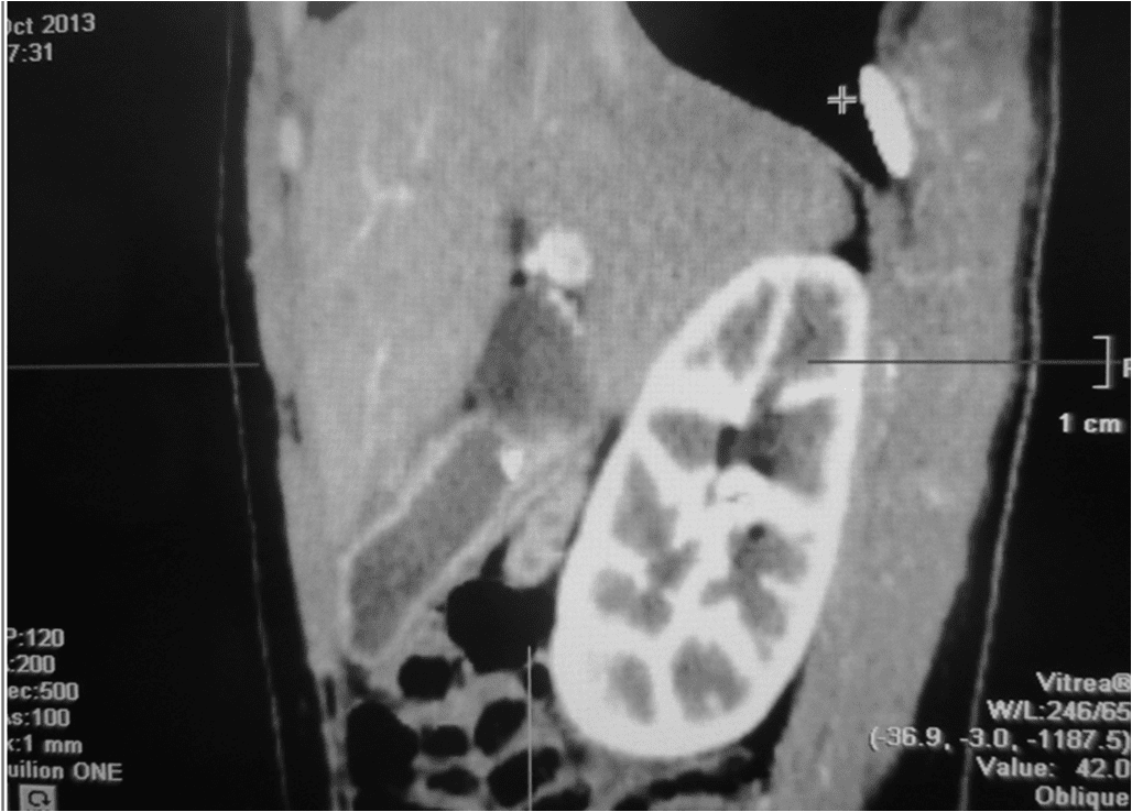 VIETNAMESE MEDIC ULTRASOUND: CASE 213: BILOBED GALLBLADDER, Dr PHAN ...