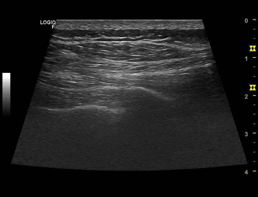 Ecografía en Atención Primaria
