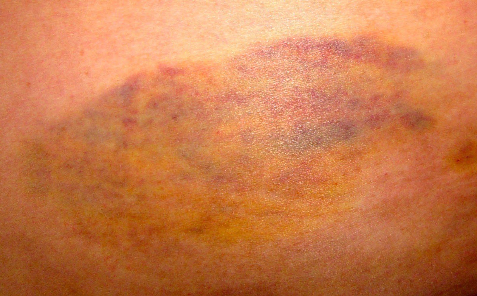 jm's Adventure with Multiple Myeloma: Summary February 1 to February 5 2013