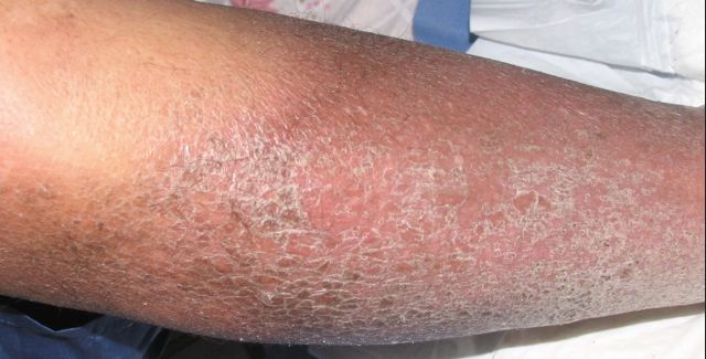 DERMATOLOGÍA : LESIONES SECUNDARIAS EN PIEL