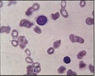 Células importantes en hematología: LEUCEMIA LINFOIDE CRÓNICA (DE ...