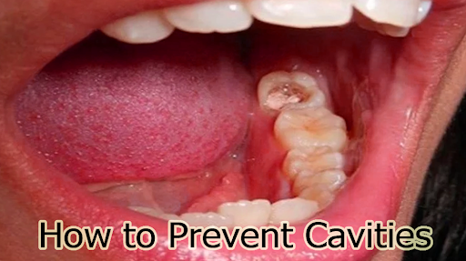 How to Prevent Cavities