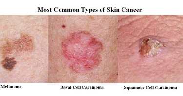 Best Hospitals For Cancer Treatment : Skin Cancer Treatment in India