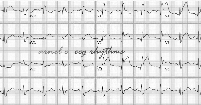 ECG Rhythms: Anterior wall STEMI