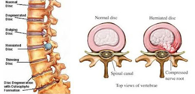 Testimoni Hilang Slipped Disc Dengan Vivix