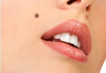 16 Cara Menghilangkan Tompel (Tanda Lahir) Dengan Cepat dan Ampuh ...