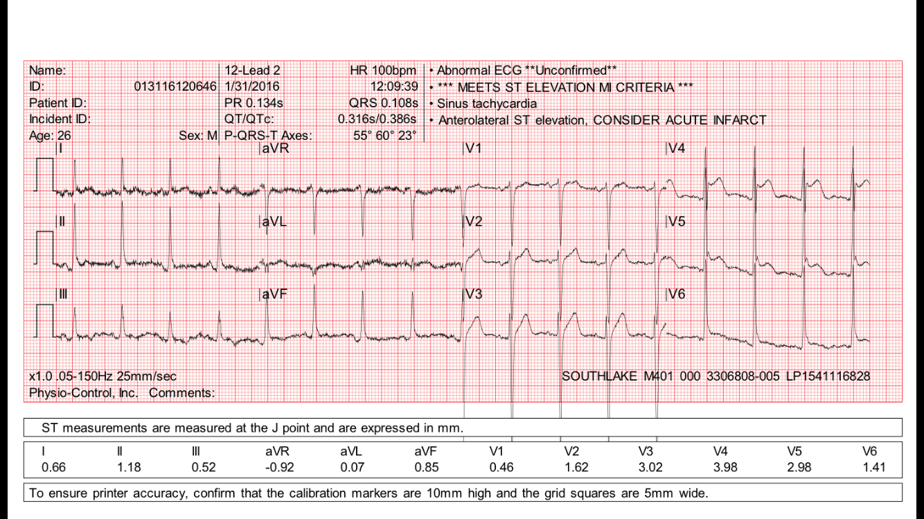 Dr. Smith's ECG Blog: Is it early repol, pericarditis, or anterior STEMI?