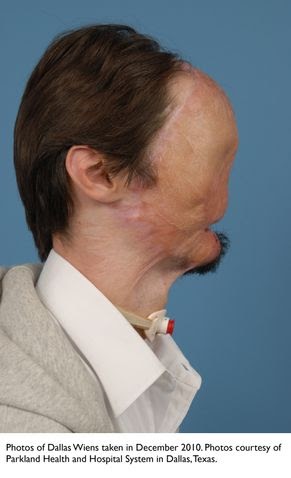 Nature and Science from ALB: Full Face Transplant