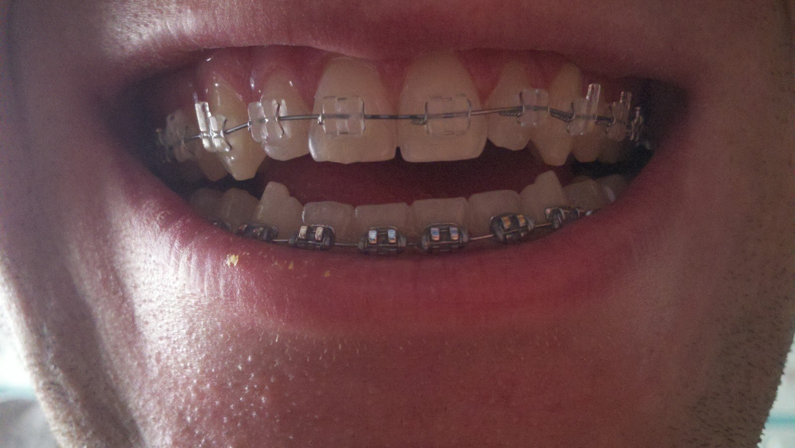 Braces/Open Bite Surgery: Brace yourself!