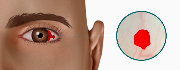 TU SALUD Y LA NUTRICIÓN.: HEMORRAGIAS OCULARES. ¿Cuales son las causas?