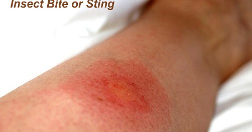 Insect Bites And Stings - Health And Medical Information