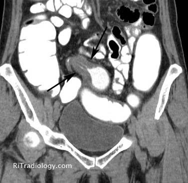 RiT radiology: Pseudothickening of Colonic Wall
