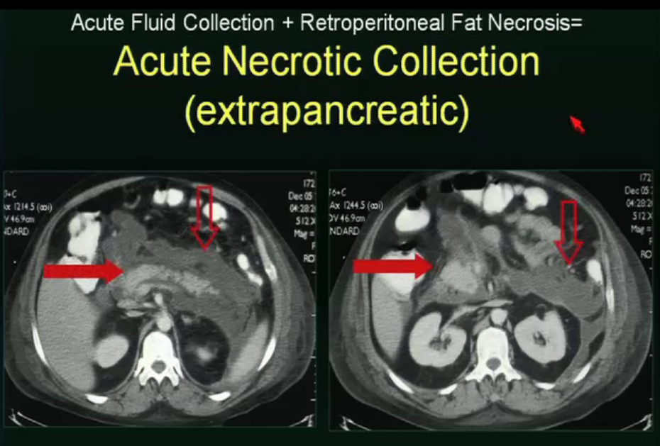 rsna: Acute pancreatitis