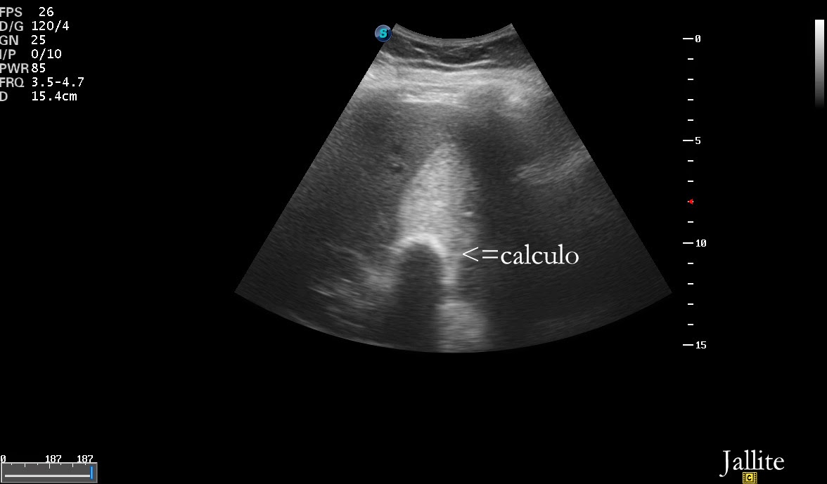 Colecistitis Cronica & Colelitiasis Única