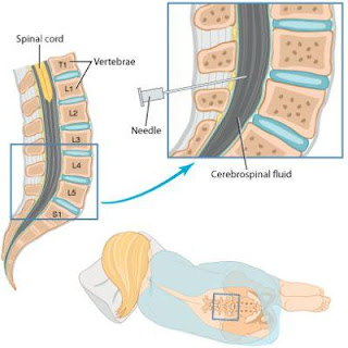 Pengertian, Prosedur, dan Risiko Pungsi Lumbal | Medkes