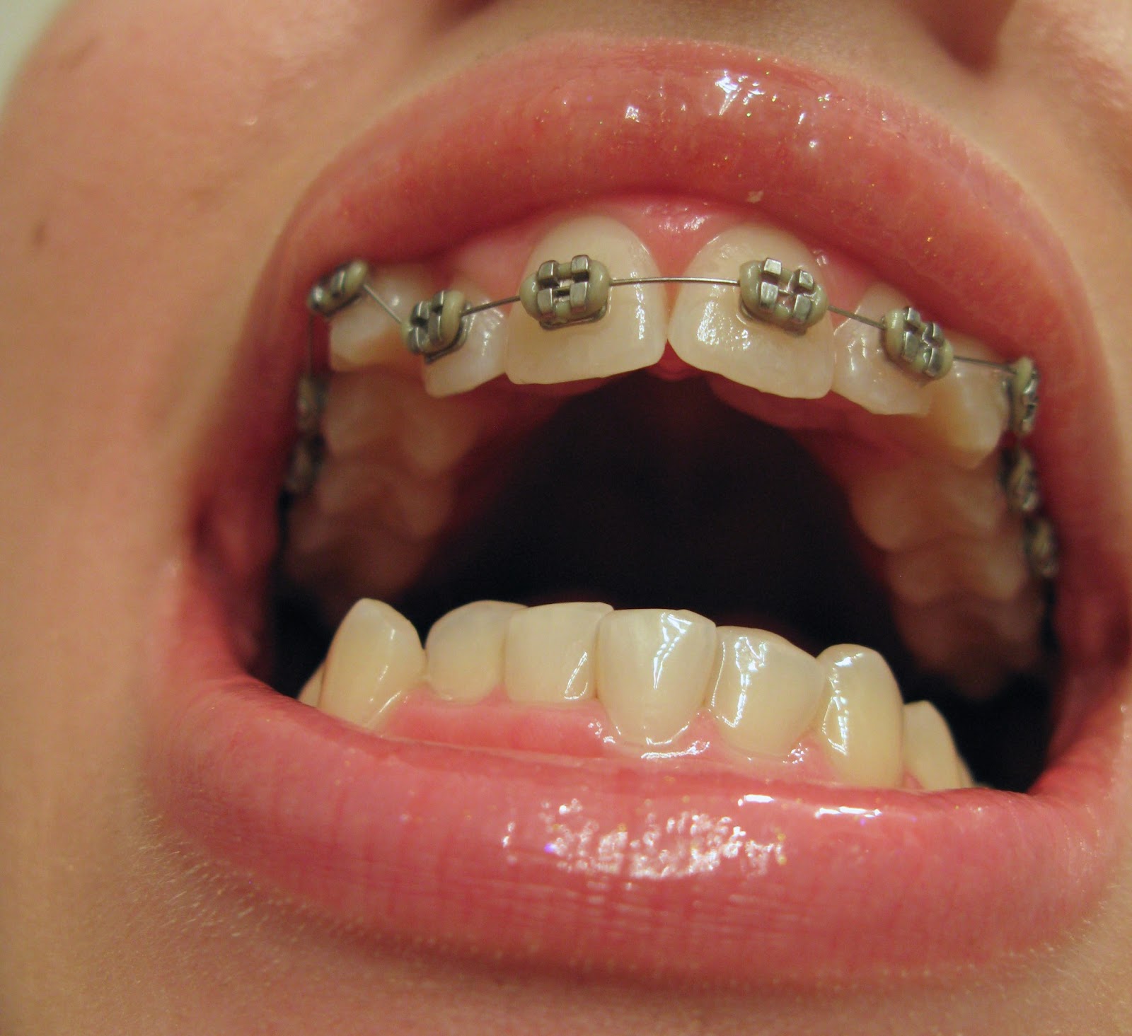 Braces at 22.