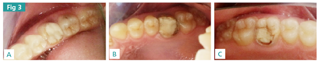 Molar Incisor Hypomineralization (MIH): Conservative Treatment Approach