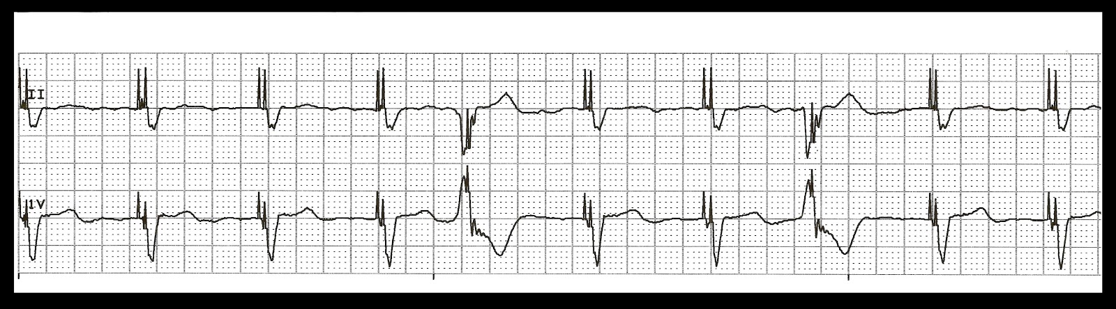 Float Nurse: EKG quiz 311
