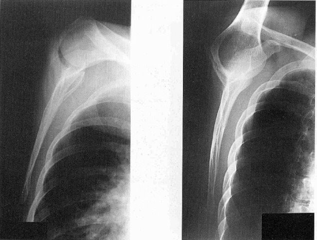 Tecnicas Radiológicas 2011: Escàpula Proyeccion Lateral posicion del ...