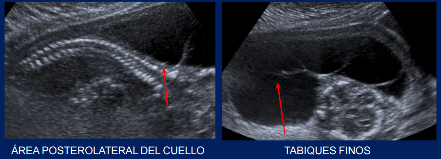 Jhoanna: Higroma quistico