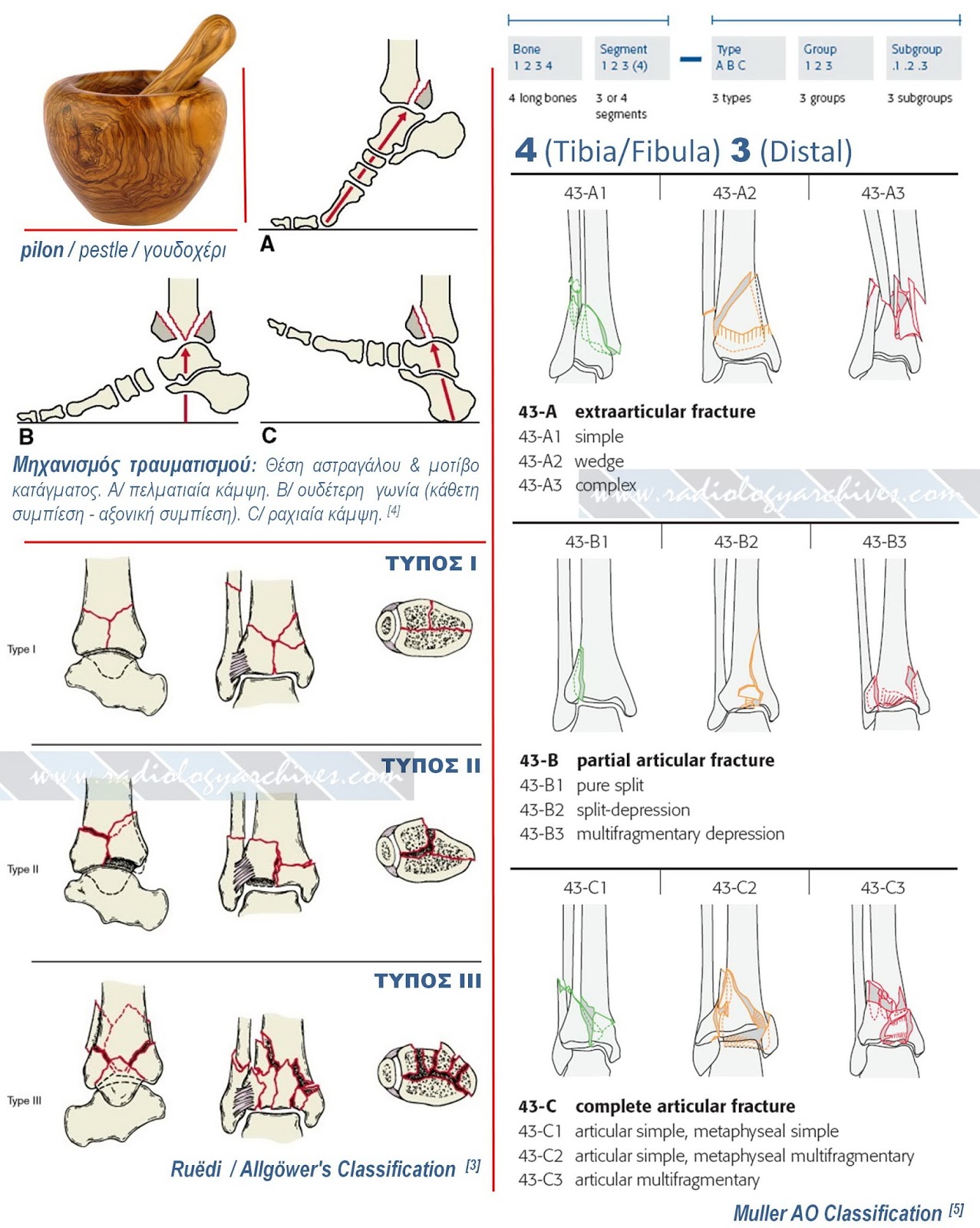 Radiology Archives: Κάταγμα Pilon* (Πολυτμηματικό Ενδοαρθρικό Κάταγμα ...