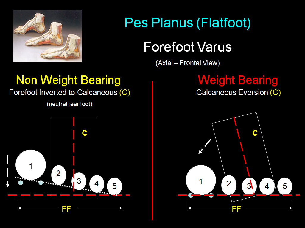 Static and Functional Biomechanical Diseases