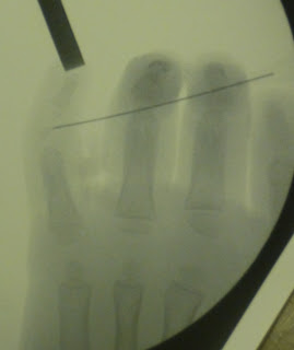 Clinodactyly Minimally Invasive Treatment | Congenital Hand and Arm ...