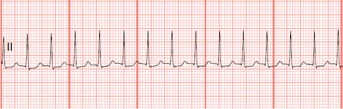 ACLS review: SVT part 1