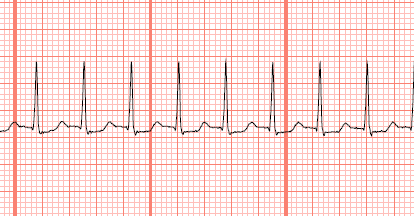 ACLS review: SVT part 1