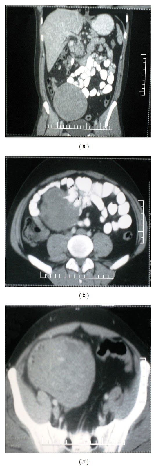 enteroclysis - USA News Collections
