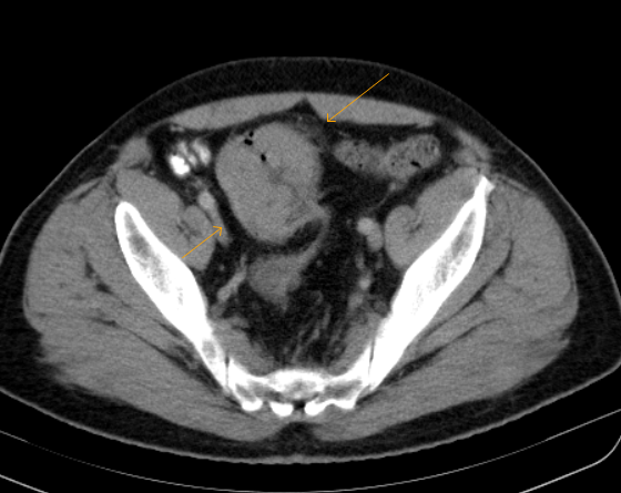 Carcinoma Sigmoid Colon-CT - Sumer's Radiology Blog